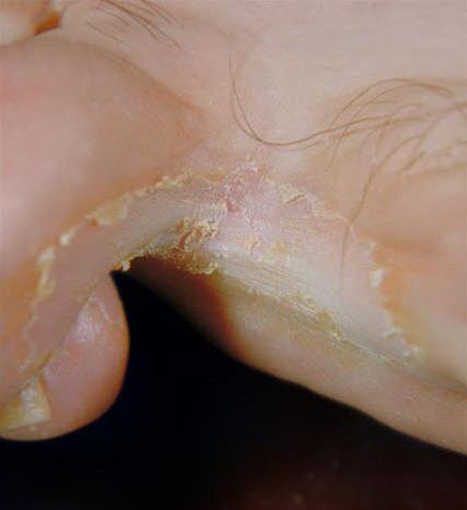 Hautausschlag an den Fußsohlen - DEXIMED – Deutsche Experteninformation ...